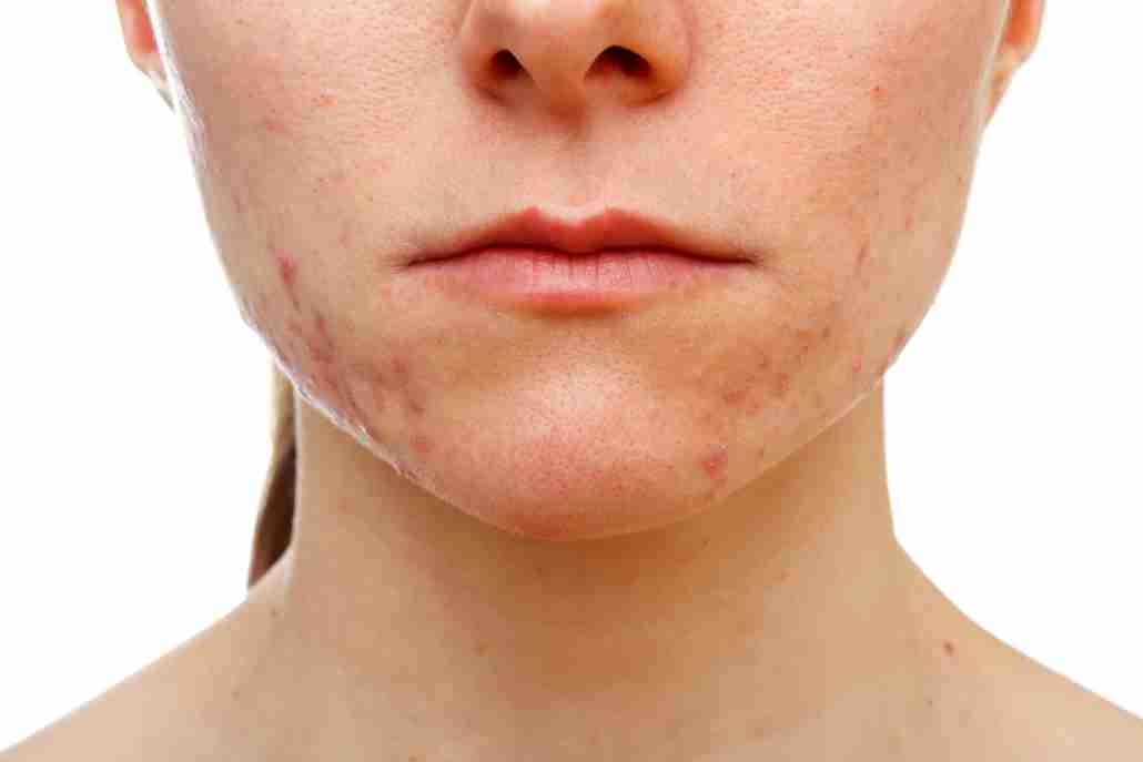 Hormonal Acne Treatment Organic Apoteke Hormonal Acne Treatment Organic Apoteke