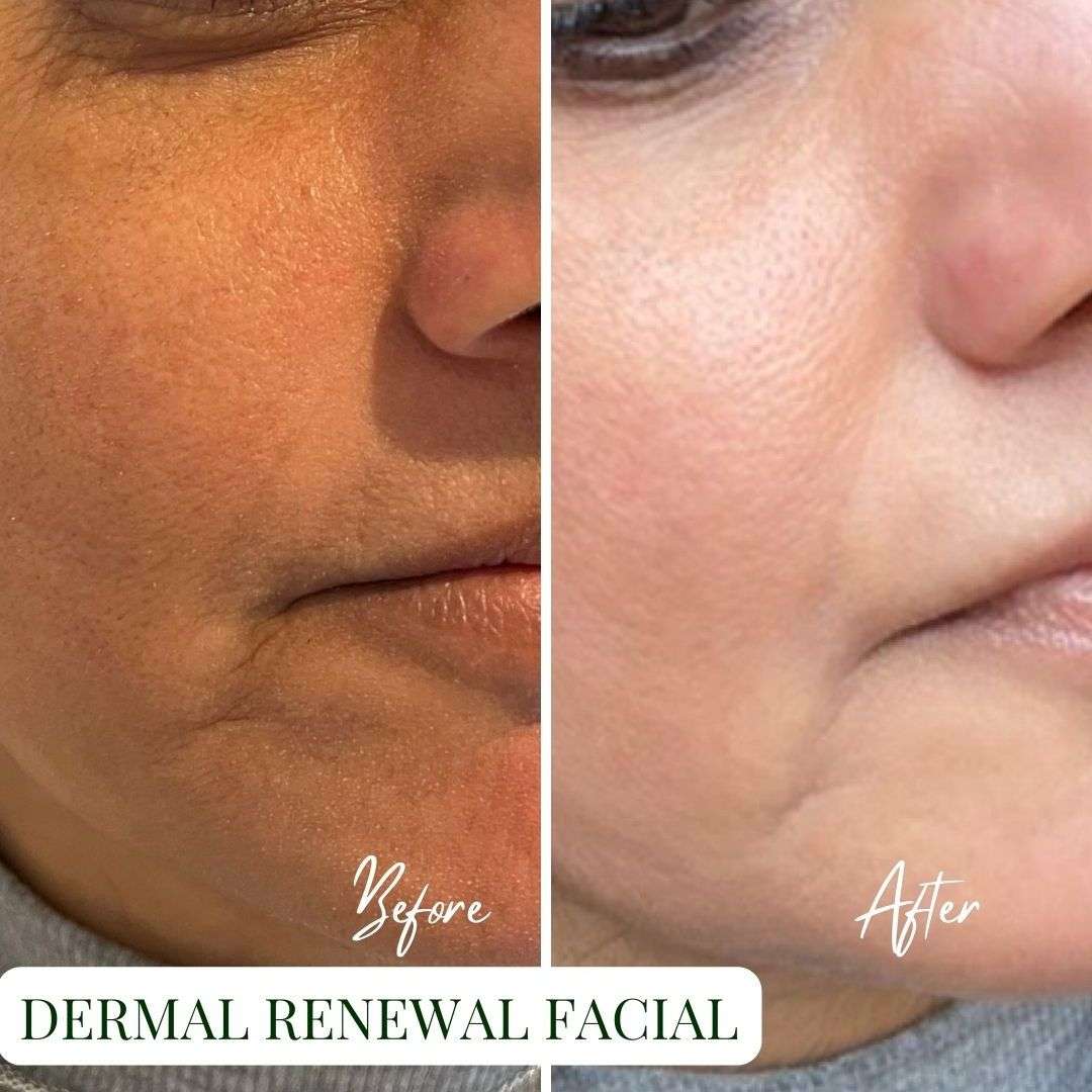 How To Remove Black Spots On Your Face At Home Infoupdate